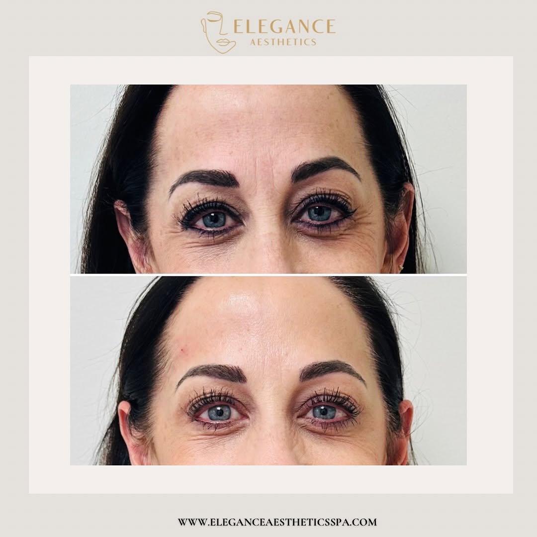 Dysport Treatment in Towson MD | Elegance Aesthetics